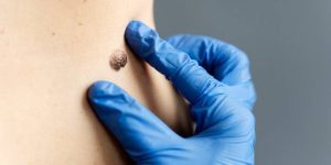 10 Jenis Kista yang Paling Umum – Morula IVF